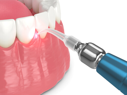 Do Gums Grow Back After Gingivectomy? Exploring Gum Regeneration